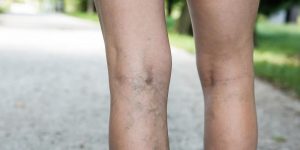 ¿Qué médico trata las varices y cuándo hay que acudir a él? - www ...