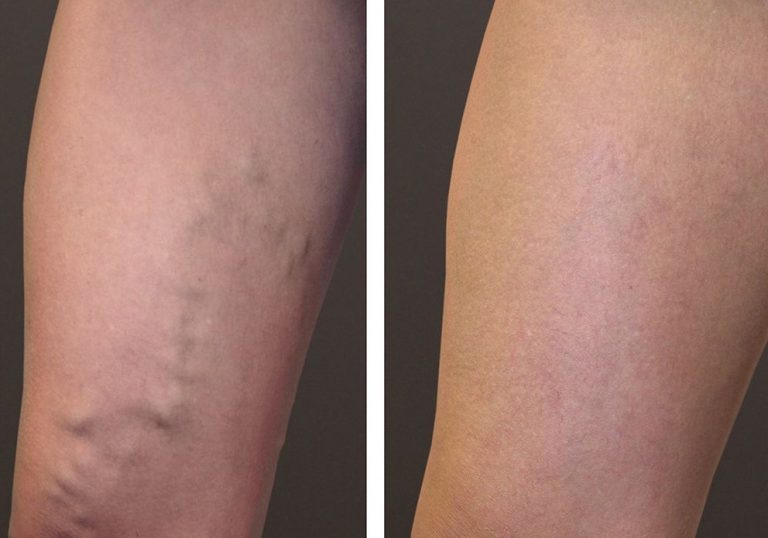 Tratamiento de varices con microespuma | Centros Varicenter