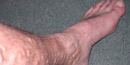 ¿Las varices pican o duelen? Todo lo que necesitas saber - www ...