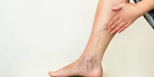 Varices tronculares: causas y síntomas de las varices en el tronco ...