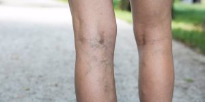 Tipos de varices según su grado y cuáles causan incapacidad - www ...