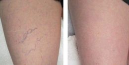 Tratamiento para los vasos capilares rotos | Centros Varicenter